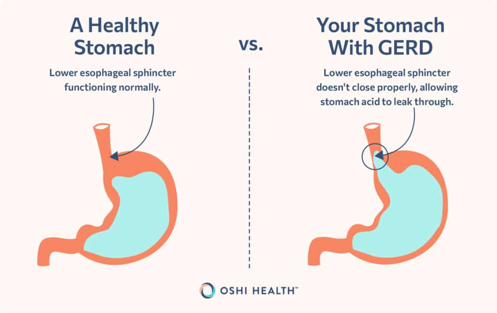 Acid reflux and GERD 101: Symptoms, causes, and treatments - Oshi Health