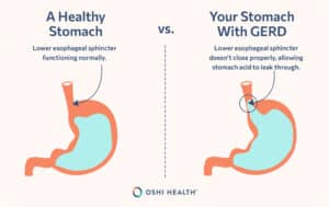 Acid reflux and GERD 101: Symptoms, causes, and treatments - Oshi Health