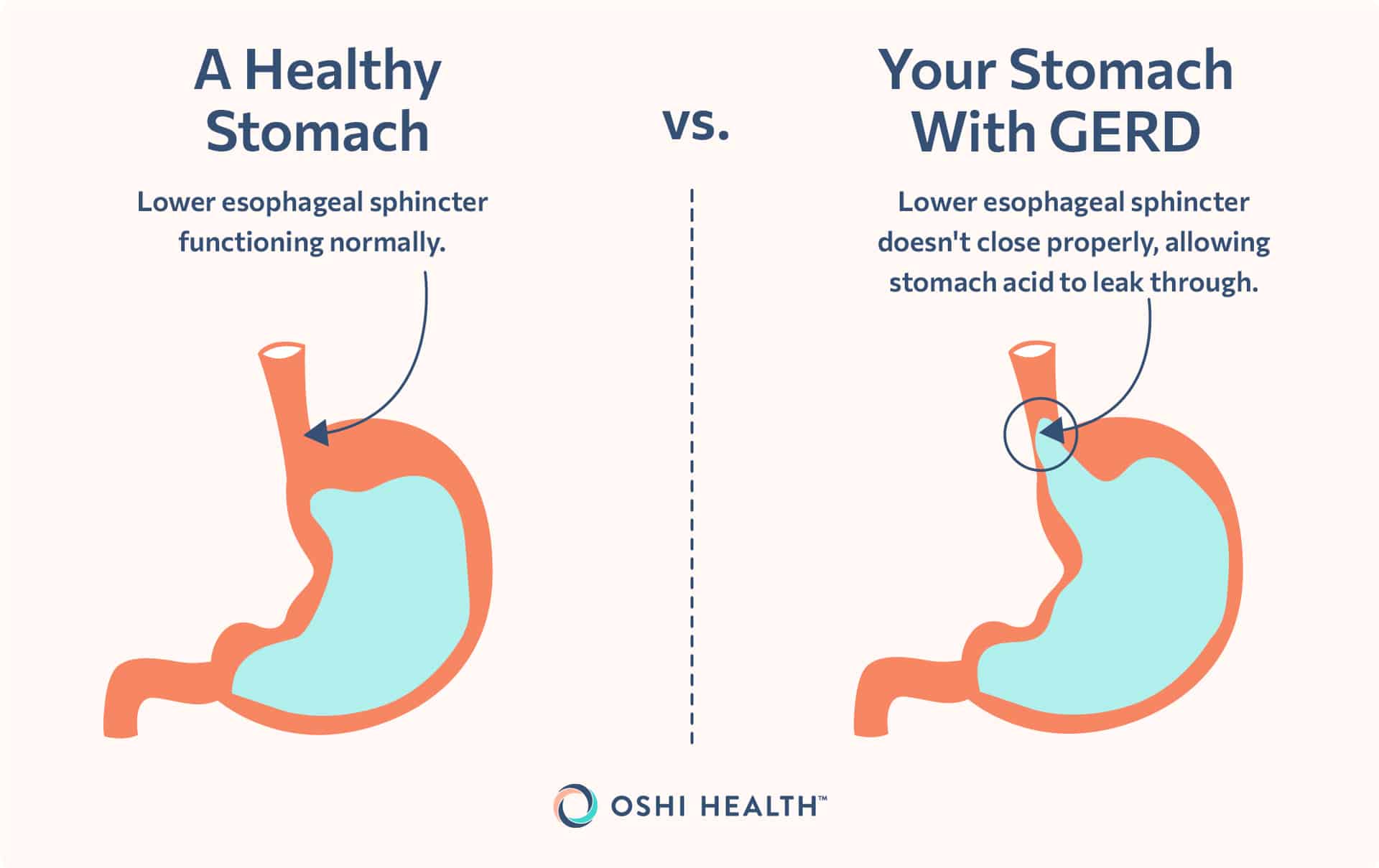 Acid reflux and GERD 101: Symptoms, causes, and treatments - Oshi Health